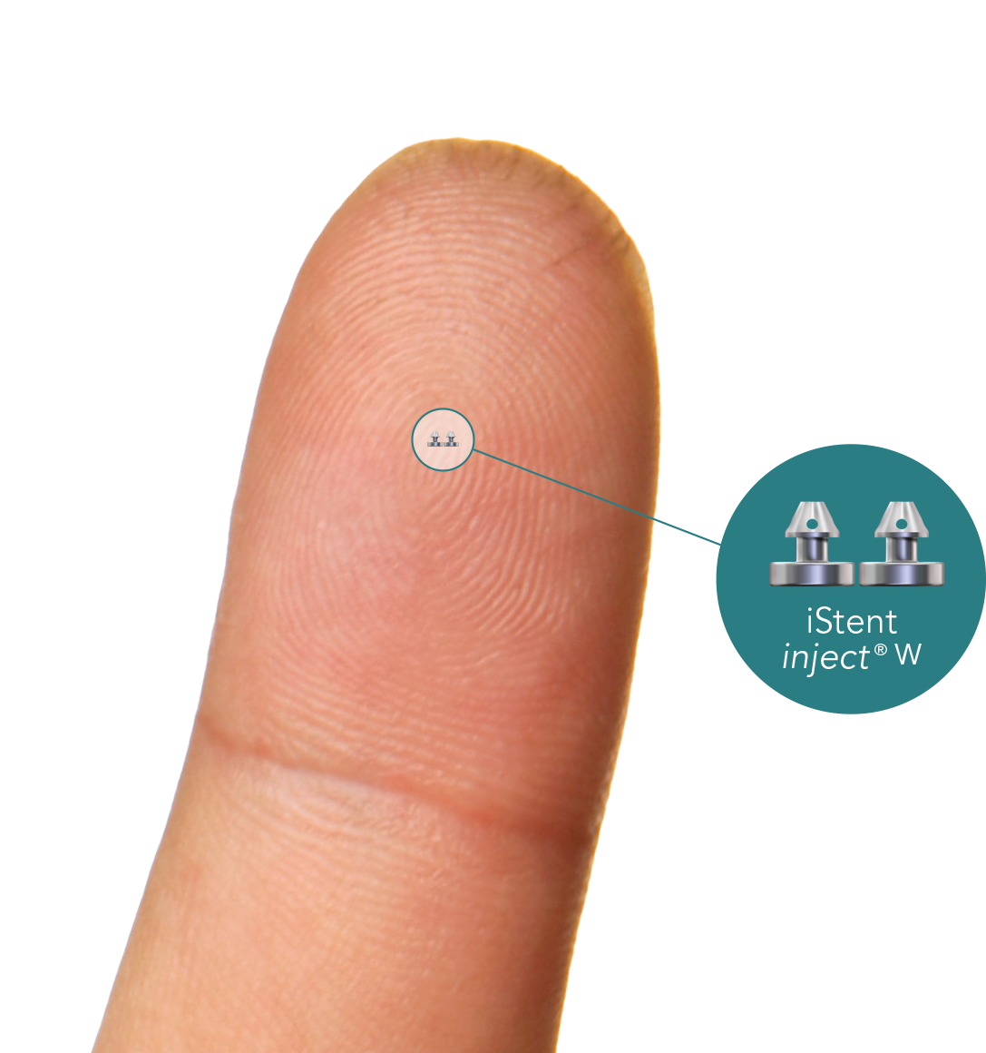 Minimally Invasive Glaucoma Surgery (MIGS) | Glaucoma Australia